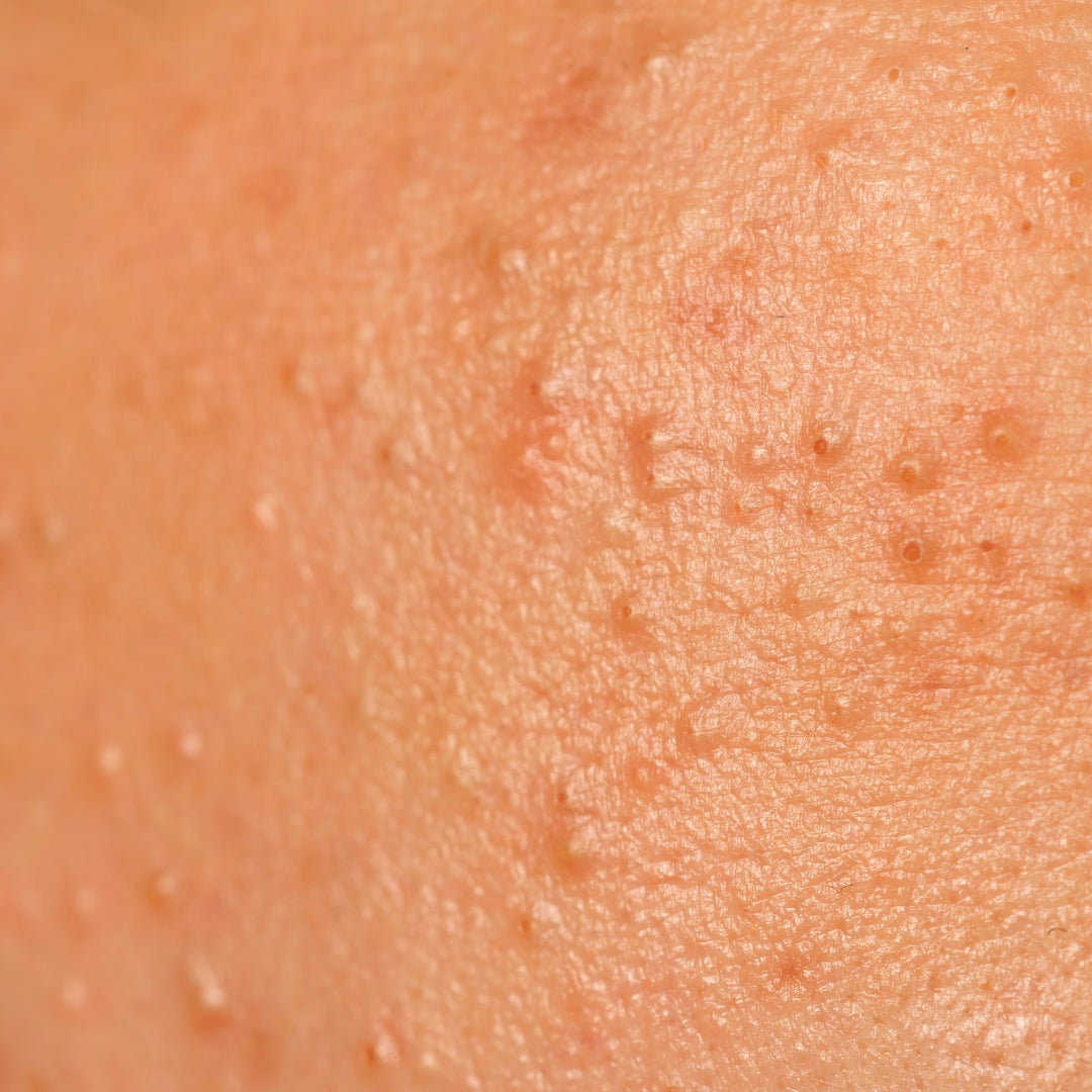 Piel con acné – Rutina coreana para controlar brotes y grasa | Dérmalux CR